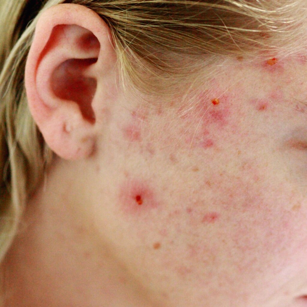 Severe cystic acne with deep nodules